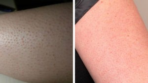 Causes et Traitment des petits points rouges sur la peau